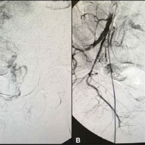 Image result for Angiogram with Embolization