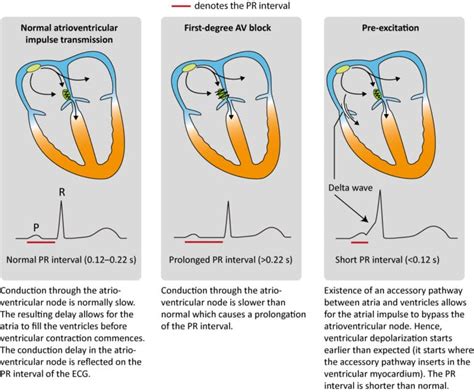 Image result for Normal PR Interval Fetus
