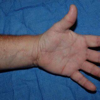 Image result for Hand Angiogram