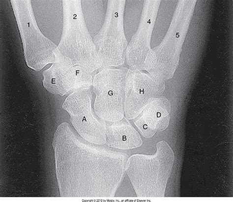 Image result for Wrist Arthrogram