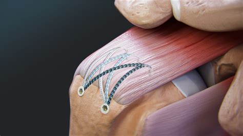 Image result for SpeedBridge Rotator Cuff