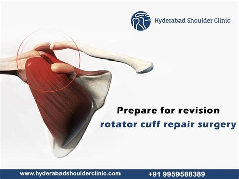 Image result for Rotator Cuff Repair Surgery