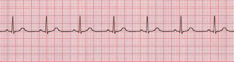 Image result for Normal EcG