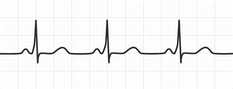 Image result for PR Interval ECG