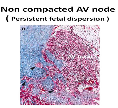 Image result for AV Node