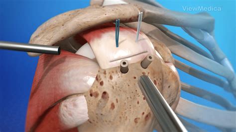 Image result for Rotator Cuff Repair Surgery