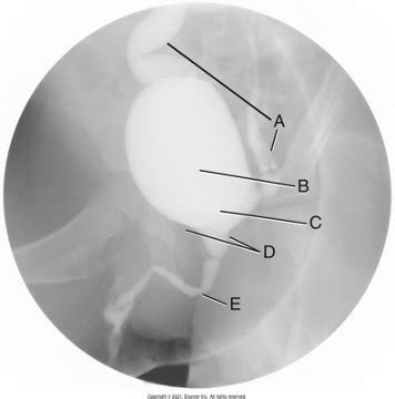 Image result for Cystourethrogram
