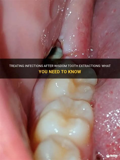 Image result for Infected Wisdom Tooth Extraction