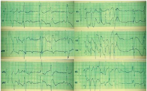 Image result for ECG 12 Derivaciones Normal