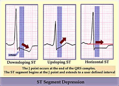 Image result for Types of ST Depression