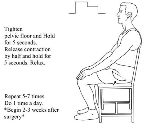 Image result for Exercise After Radical Prostatectomy