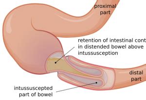 Intussusception - WikEM