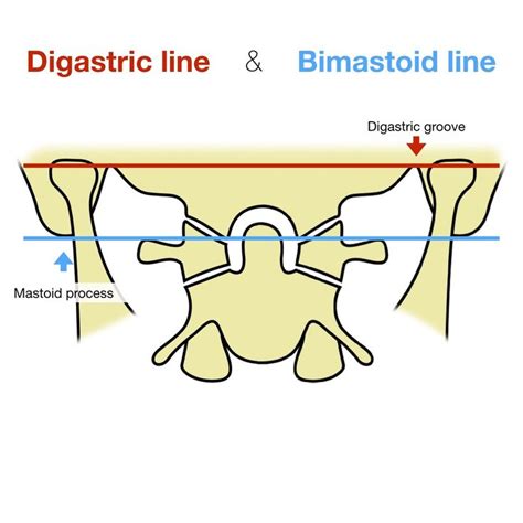 Image result for Basilary Invagination