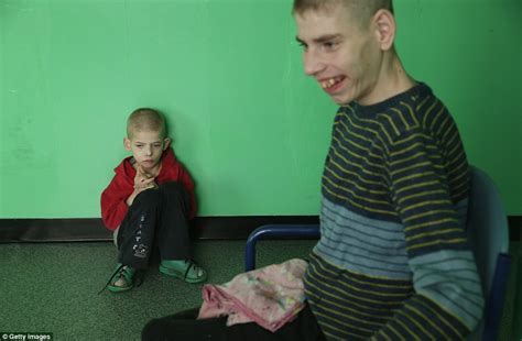 Image result for Birth Defects From Chernobyl Disaster