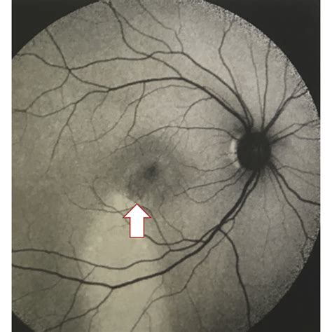 Image result for Oct Line Scan