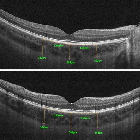 Image result for Oct Line Scan