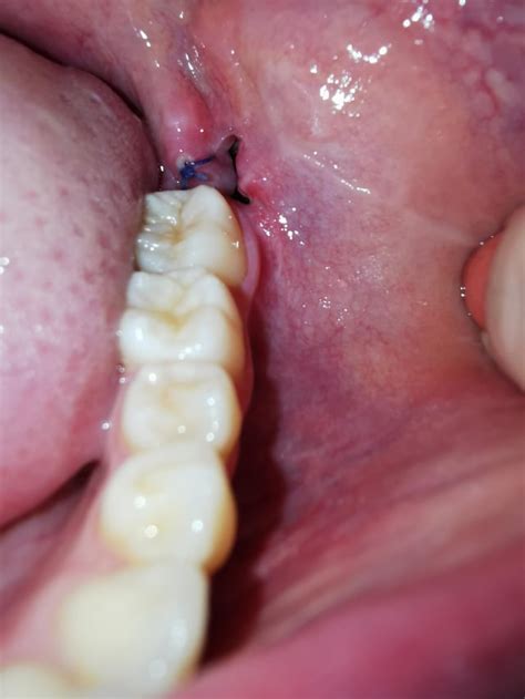 Image result for Infected Tooth Extraction