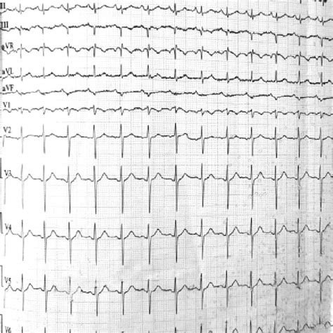 Image result for Normal EcG