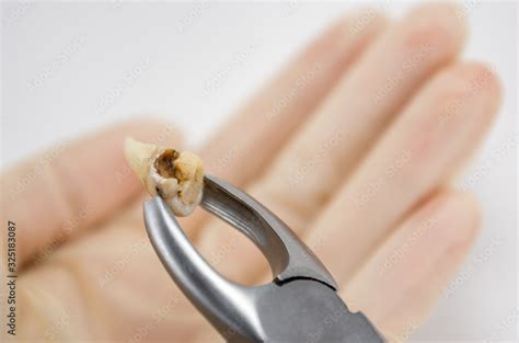 Image result for Cavity Tooth Extraction