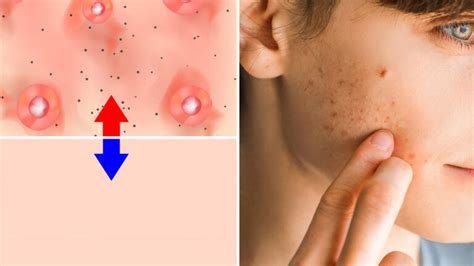Image result for How to Avoid Pimples