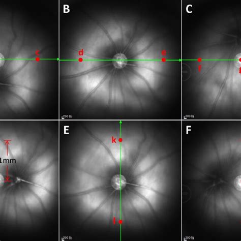 Image result for Oct Retinal Scan Interpretation