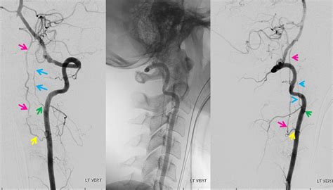 Image result for Spinal Angiogram
