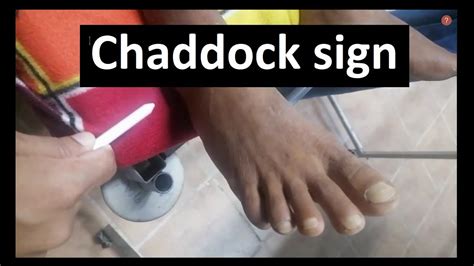 Image result for Chaddock Reflex Video