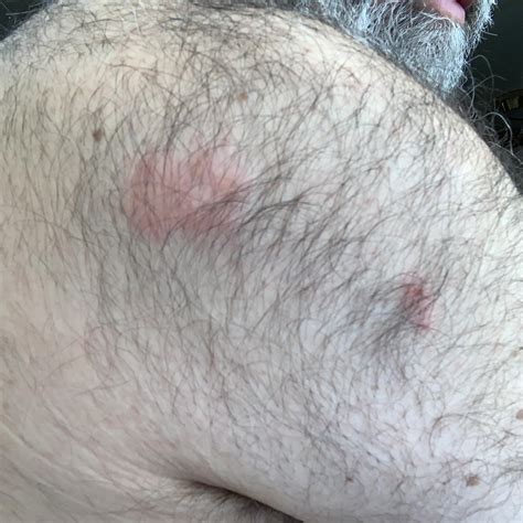 Image result for Shingles On Arm