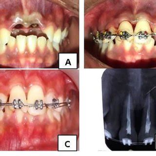 A. Photograph before replantation of avulsed tooth; B. Splinting of the ...