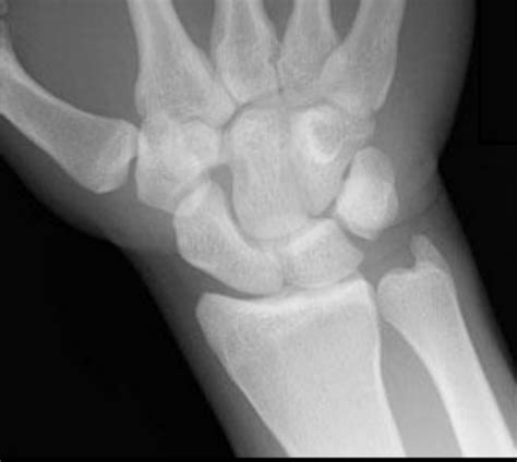 Image result for Wrist Arthrogram
