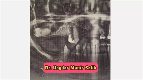 Image result for Principles of Tooth Extraction