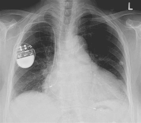 Image result for Remove a Pacemaker and Install Defibrillator