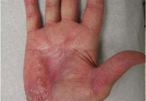 Image result for Types of Pustular Psoriasis