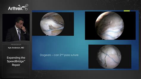 Image result for SpeedBridge Methods