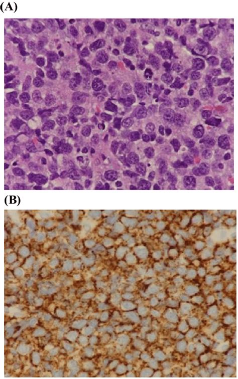 Image result for Diffuse Large Cell Lymphoma
