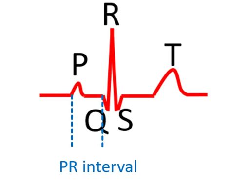 Image result for Normal PR Interval Fetus