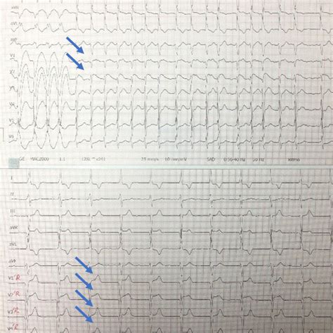 Image result for ECG 12 Derivaciones Normal
