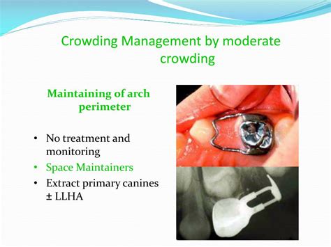 Image result for Serial Extraction Case Report