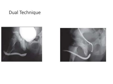 Image result for Urethrogram Procedure