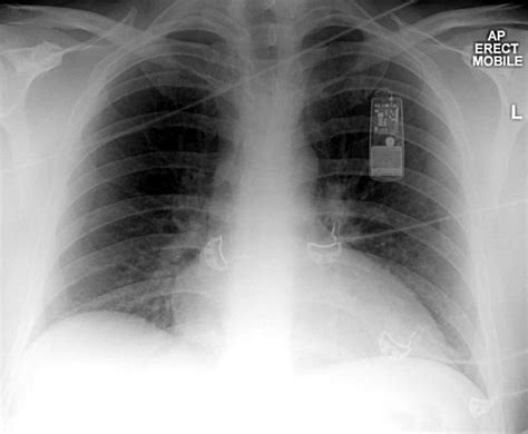 Image result for Insertable Loop Recorder