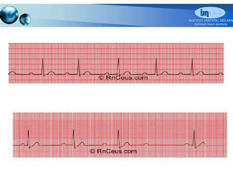 Image result for 300Ms PR Interval