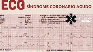 Image result for ECG 12 Derivaciones Normal