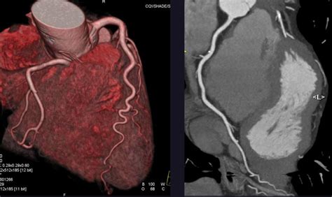 Image result for Normal Coronary CT Angiogram