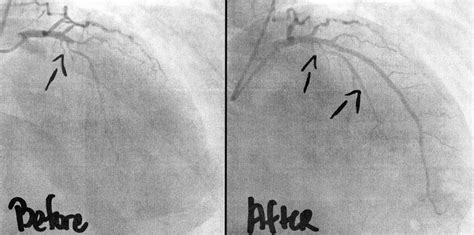 Image result for Normal Coronary CT Angiogram