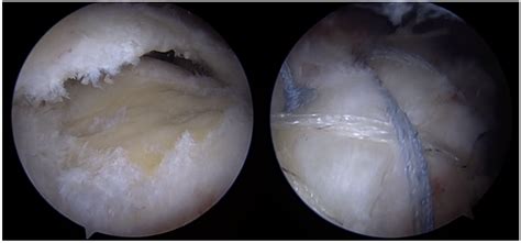 Image result for Rotator Cuff Repair Surgery