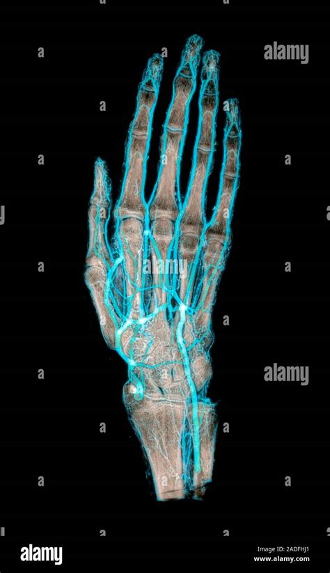 Image result for Hand Angiogram