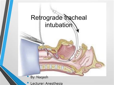 Image result for Retrograde Intubation