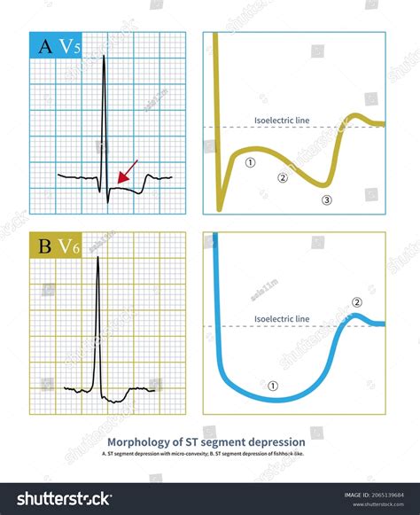 Image result for Types of ST Depression