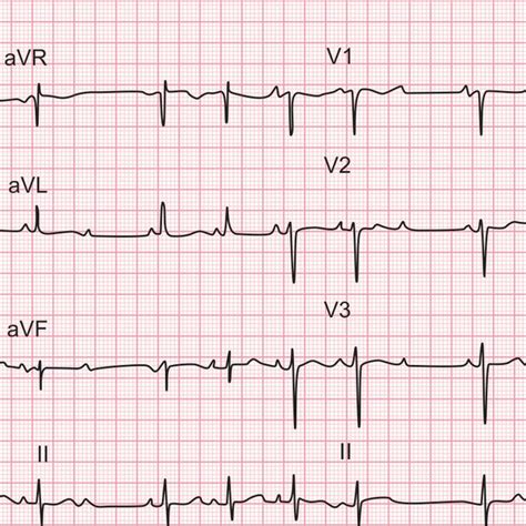 Image result for AV Block PR Interval