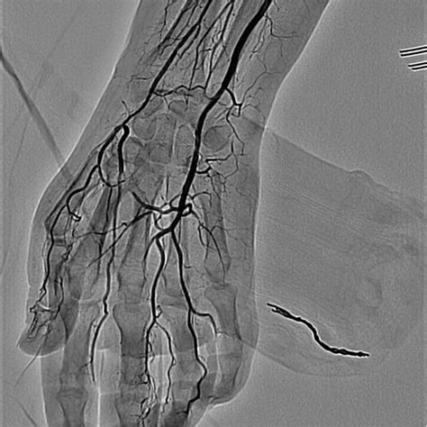 Image result for Hand Angiogram